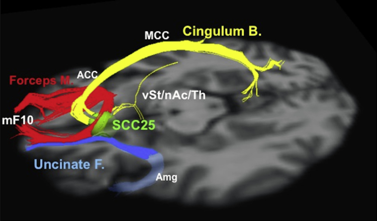 Helen Mayberg's treatment for treatment-resistent depression - How ...